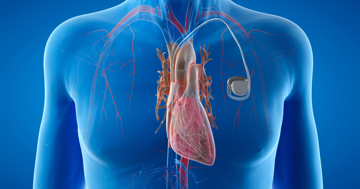 A navigation system to guide placement of cardiac pacemaker leads ...