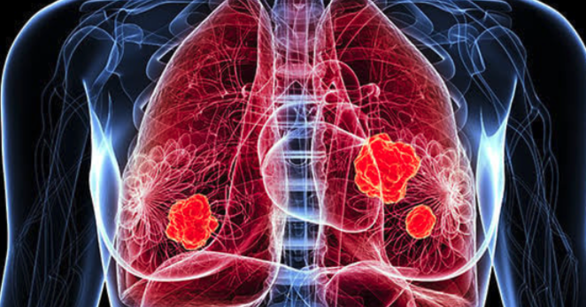 Improving our understanding and detection of lung cancer cachexia ...